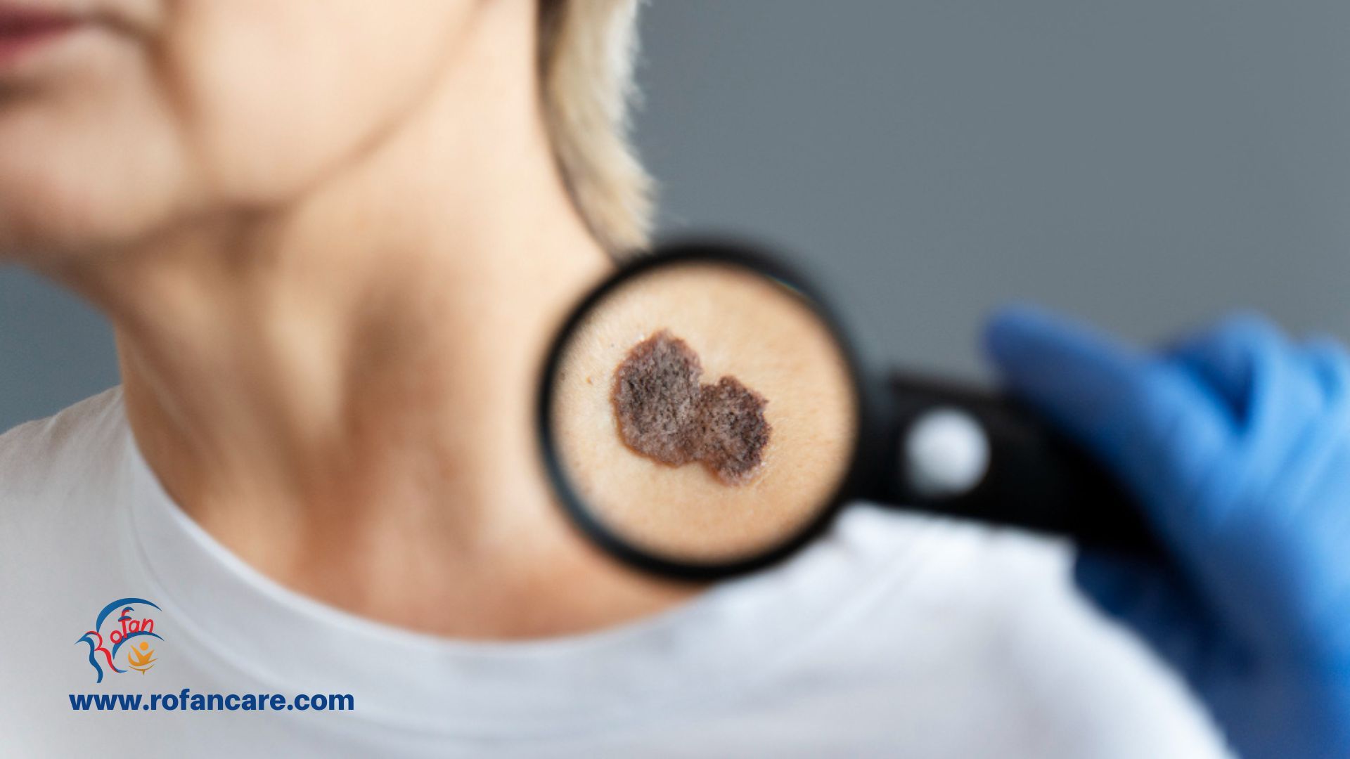 مقالات | أعراض سرطان الجلد وأنواعه |Rofancare